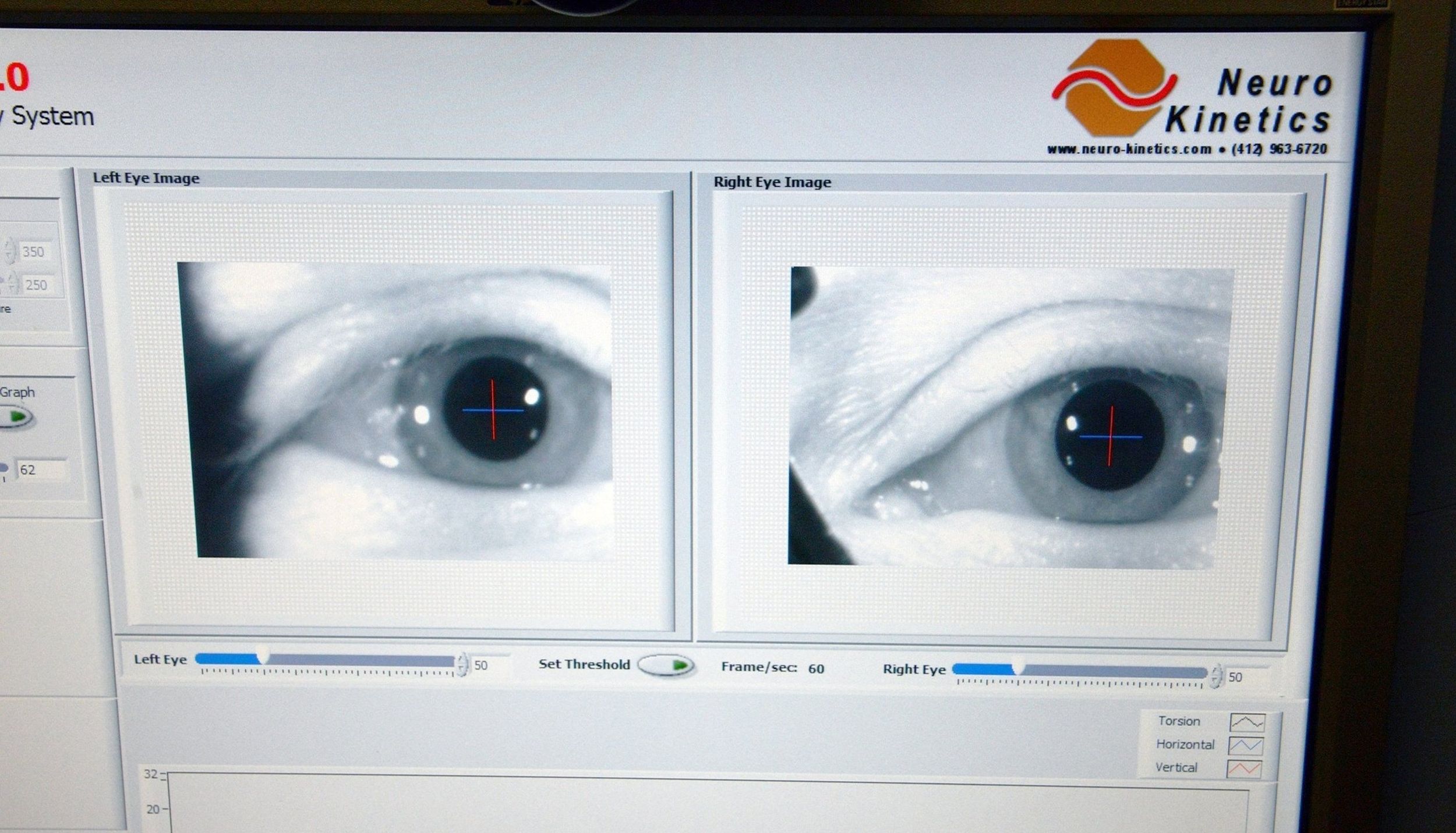 Concussion analysis focuses on eye test