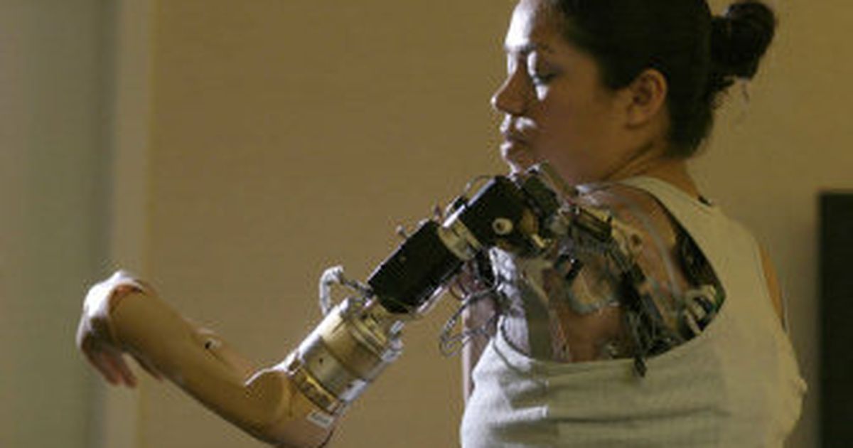 New bionic arm has changed woman's life